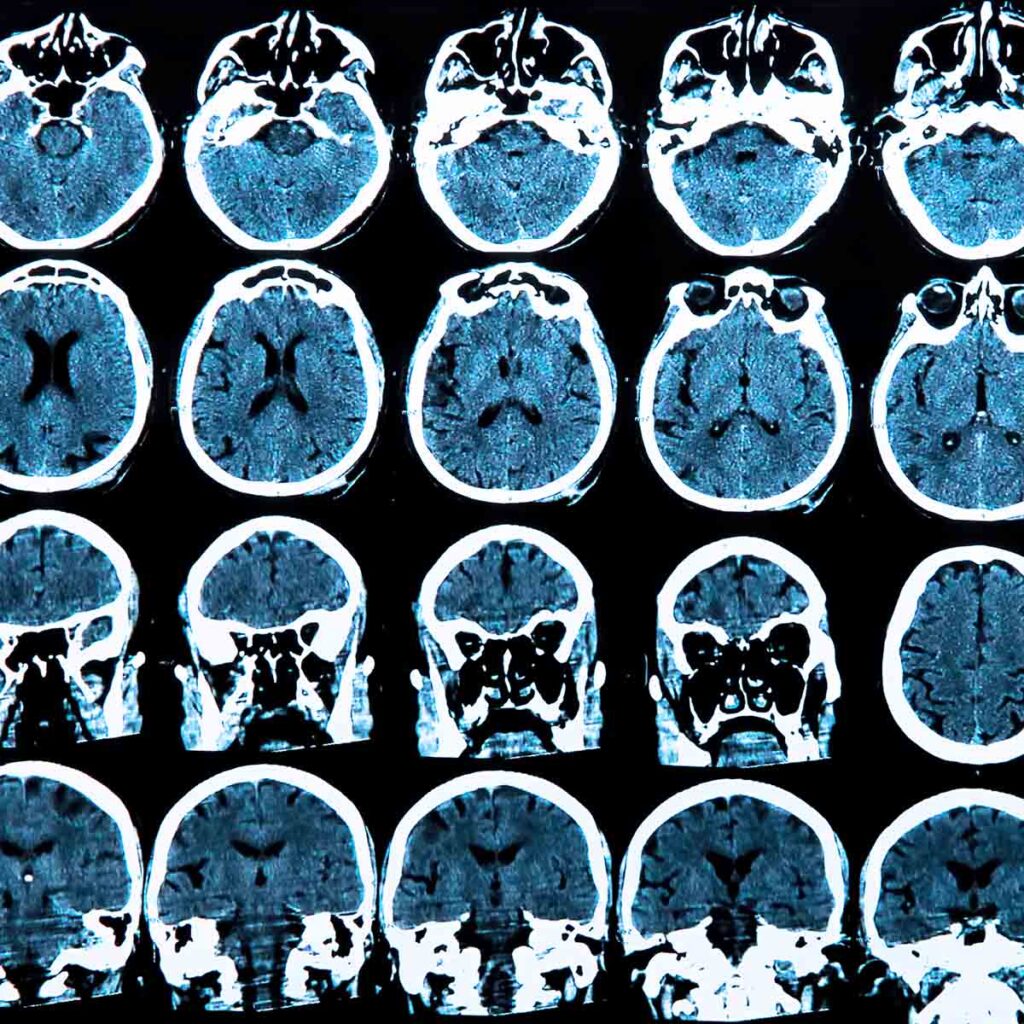 Huntington s Disease Under The Microscope HRW Healthcare Market Research Huntington s Disease Under The Microscope HRW Healthcare Market Research